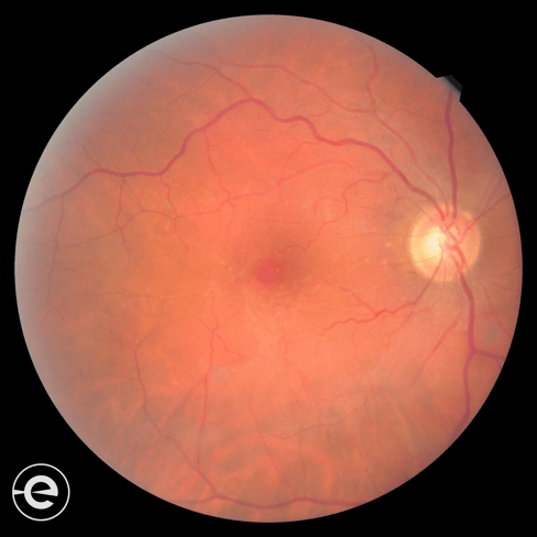Epiretinal fibrose (epiretinal membran)